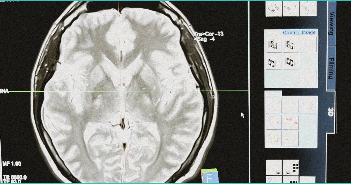 Chronic Alcohol Use Endocannabinoid System Impact Study