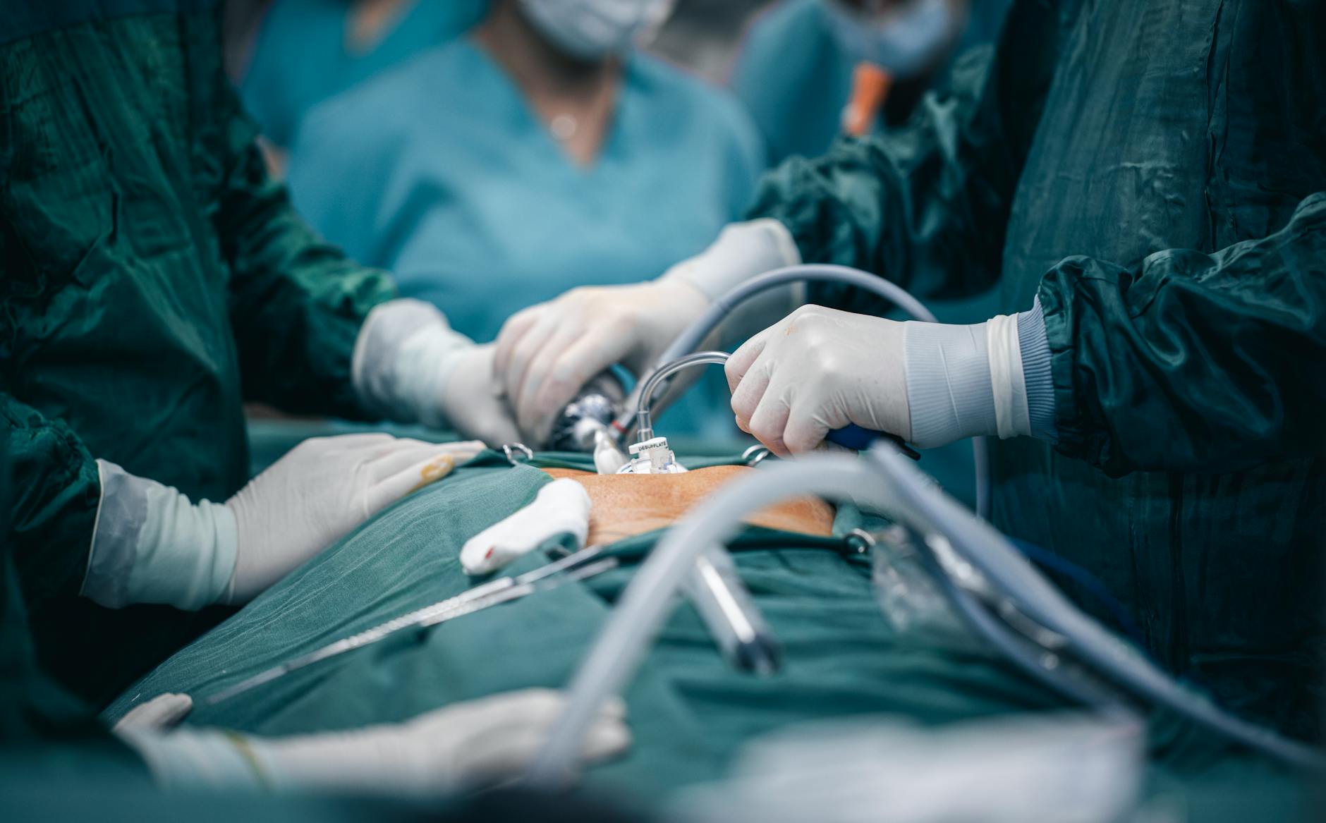 Comparative Study Laparoscopic Cholecystectomy Outcomes